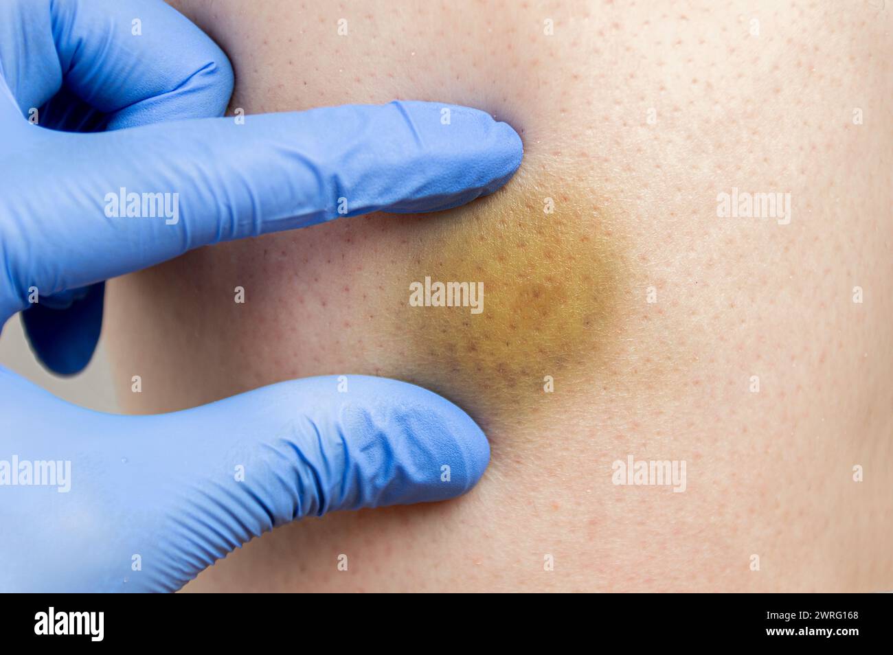 Close-up image of a doctor checking the hematoma on the skin after a ...