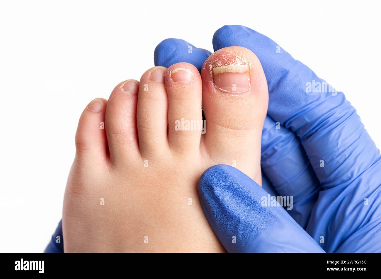 Big toe fracture hi-res stock photography and images - Alamy