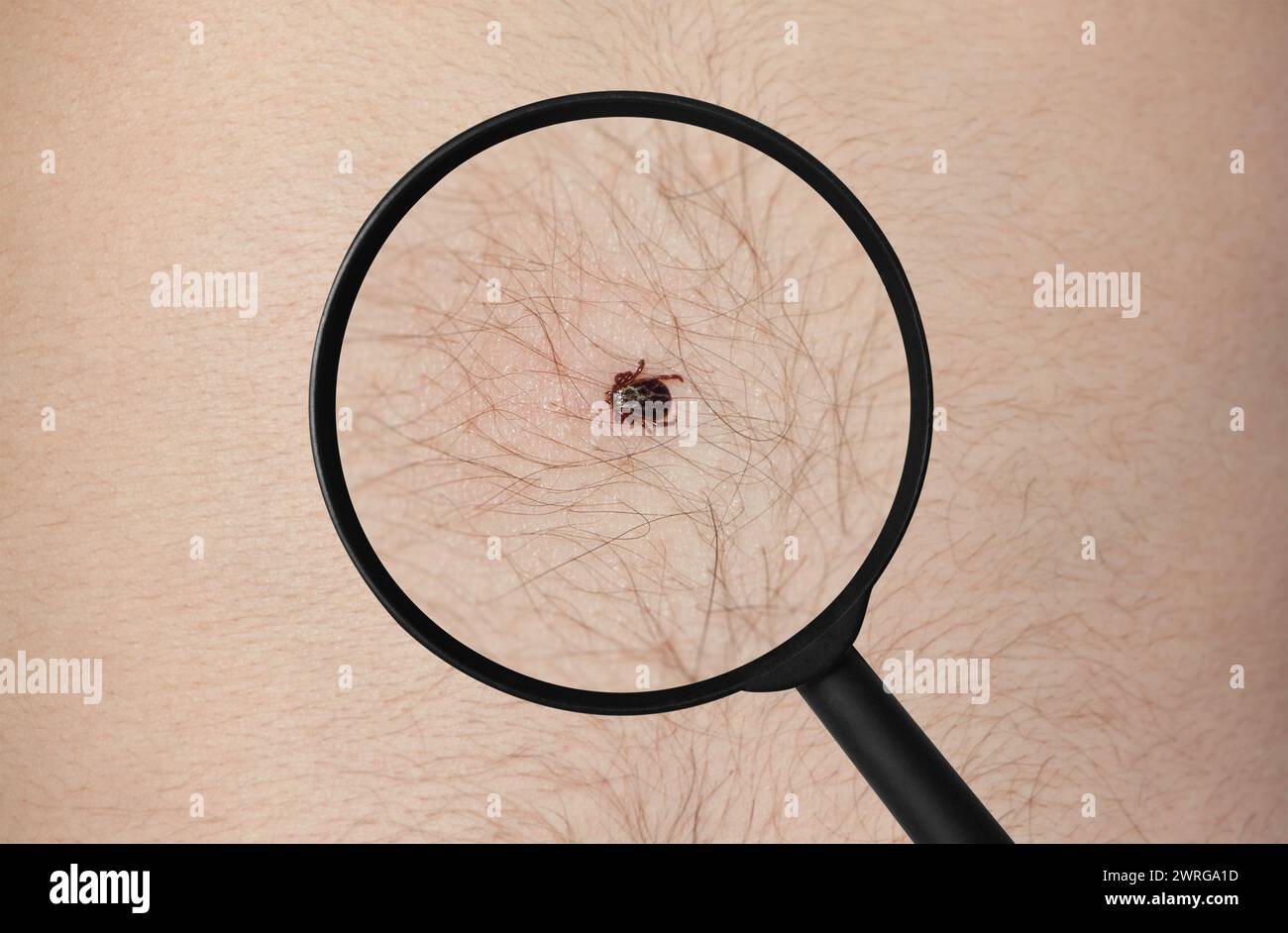 A large tick is sitting on the skin of a man, and magnified under a ...