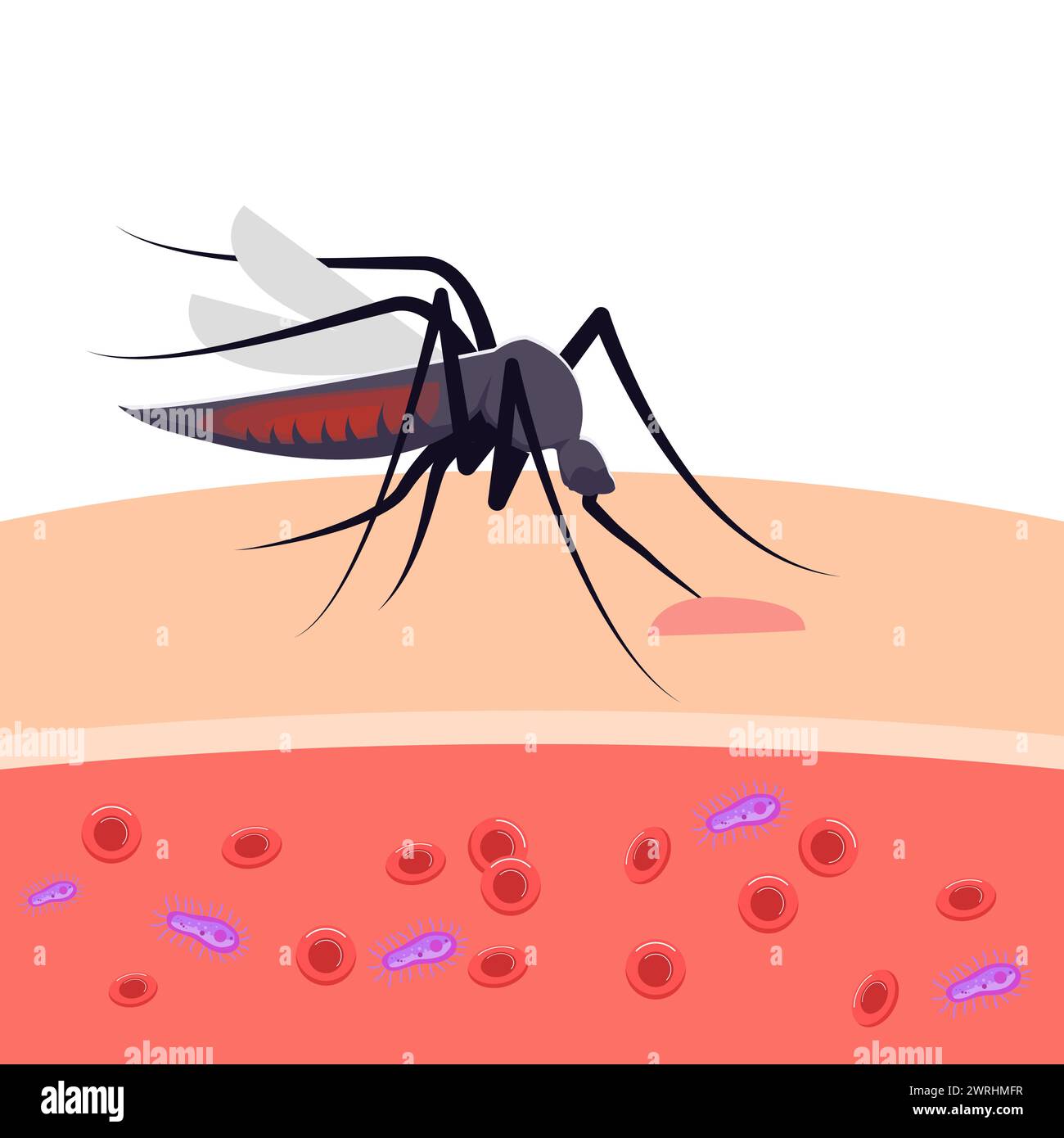 illustration mosquitoes bite the skin and infection parasites Stock ...