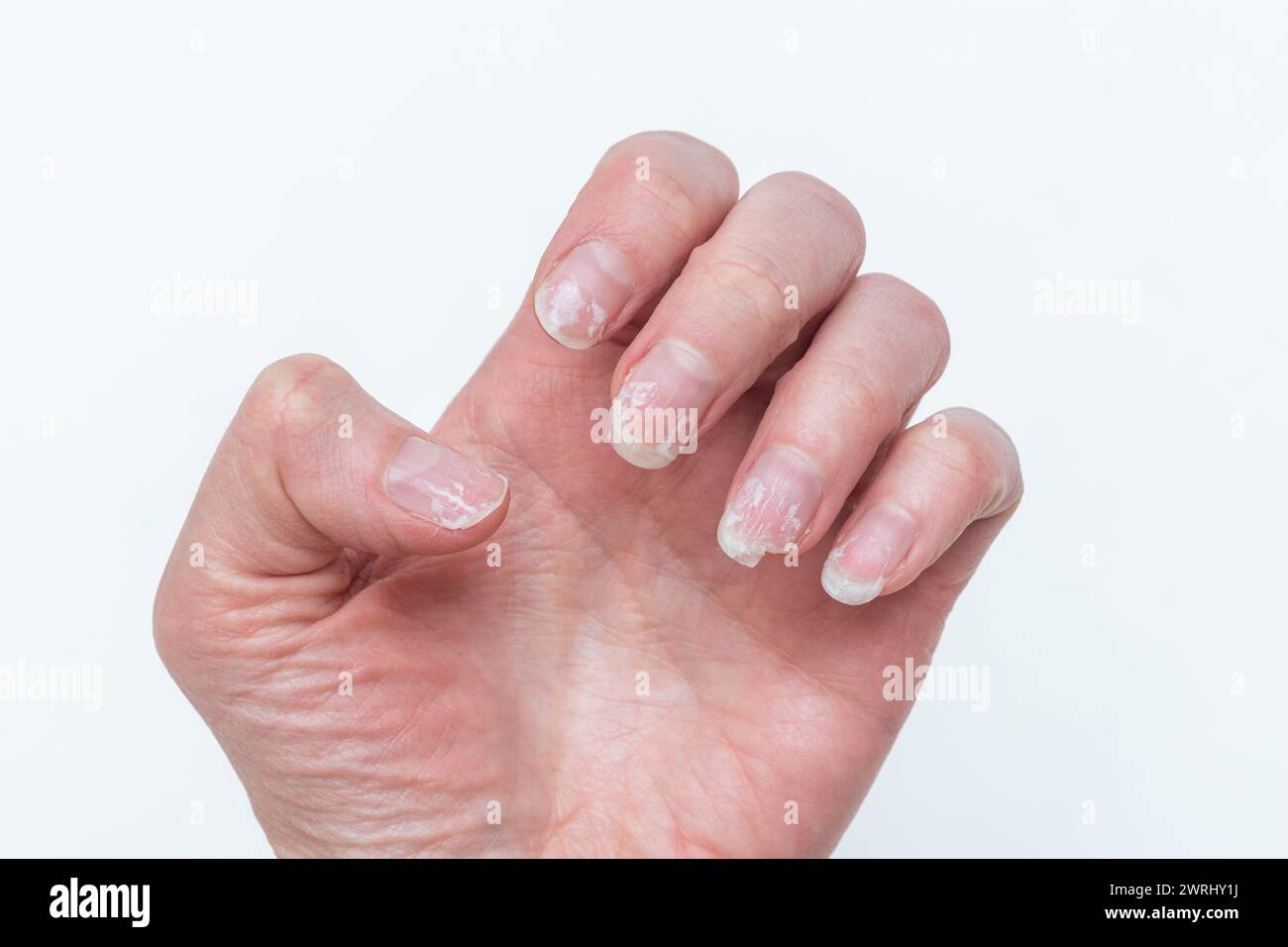 Overgrown cuticle hi-res stock photography and images - Alamy