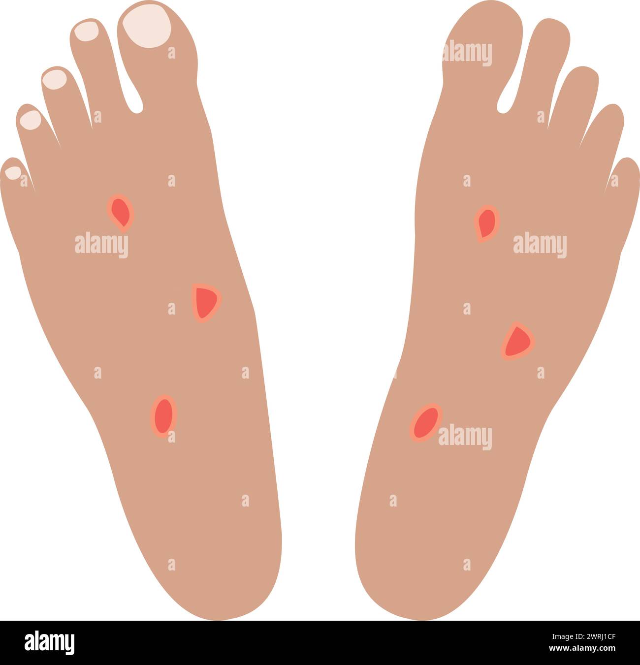Diabetic foot, ulcer and disease, diabetic foot vector icon, vector ...