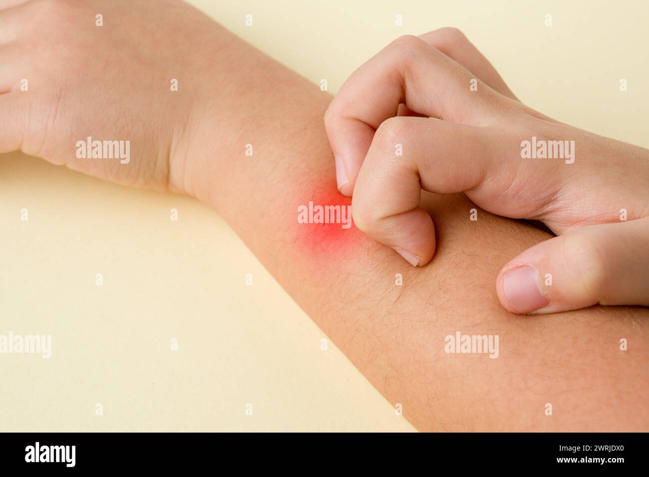 Red spot on arm hi-res stock photography and images - Alamy