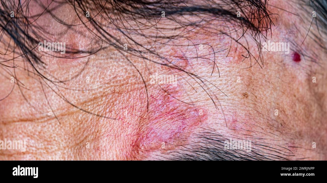 Lupus rash face hi-res stock photography and images - Alamy