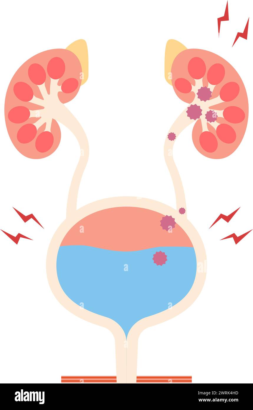 Medical illustration of pyelonephritis, the backflow of bacteria from ...