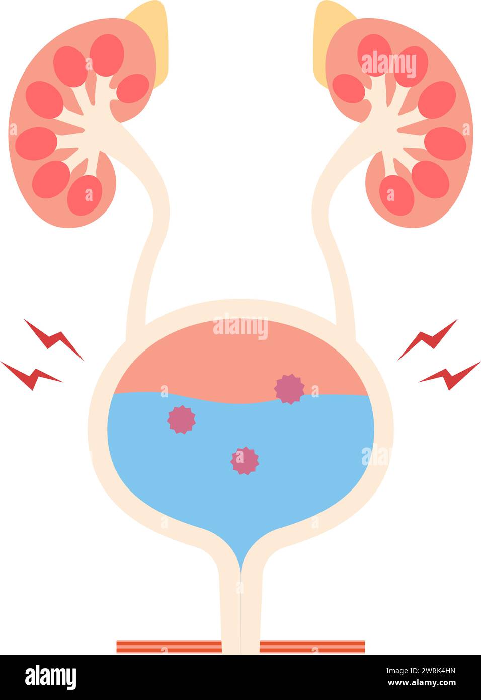 Medical illustration of cystitis, urethra, bladder, ureter, kidney ...