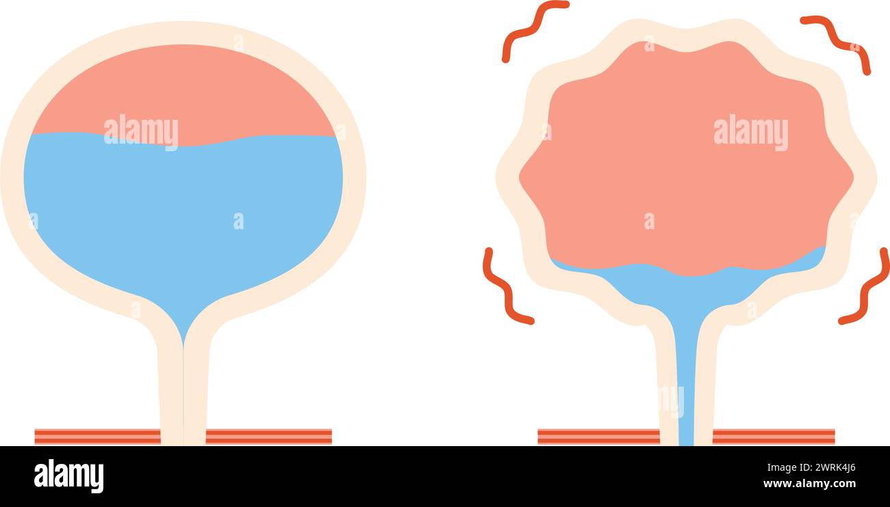 Medical illustration of overactive bladder, normal bladder vs, Vector ...