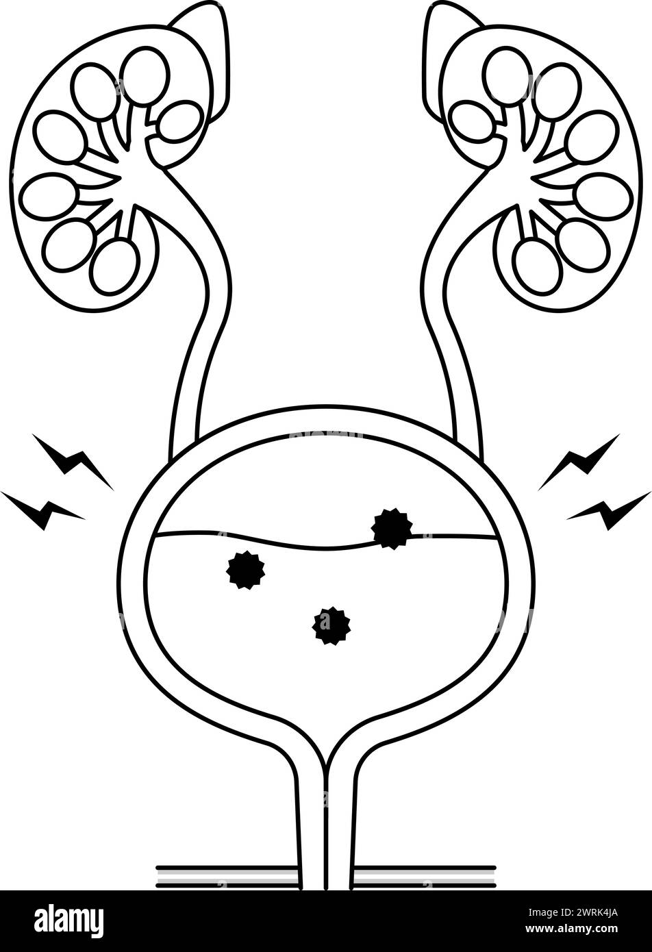 Medical illustration of cystitis, urethra, bladder, ureter, kidney ...