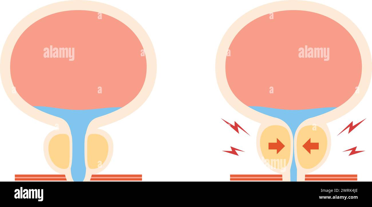 Medical illustration of benign prostatic hyperplasia, normal vs ...