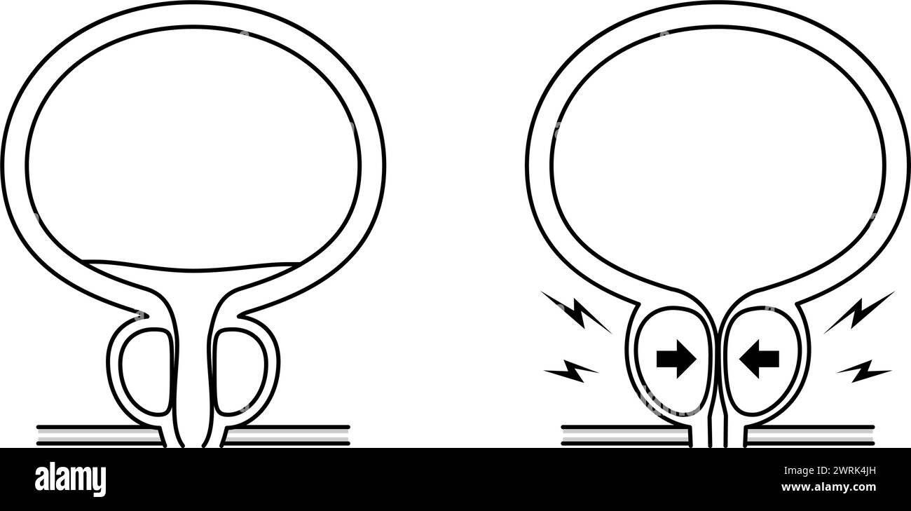 Medical Illustration Of Benign Prostatic Hyperplasia Normal Vs Enlarged Prostate Vector