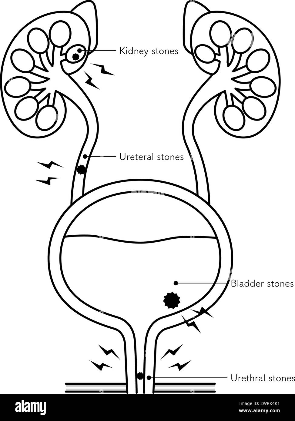 Medical illustration of urinary tract stones, Vector Illustration Stock ...