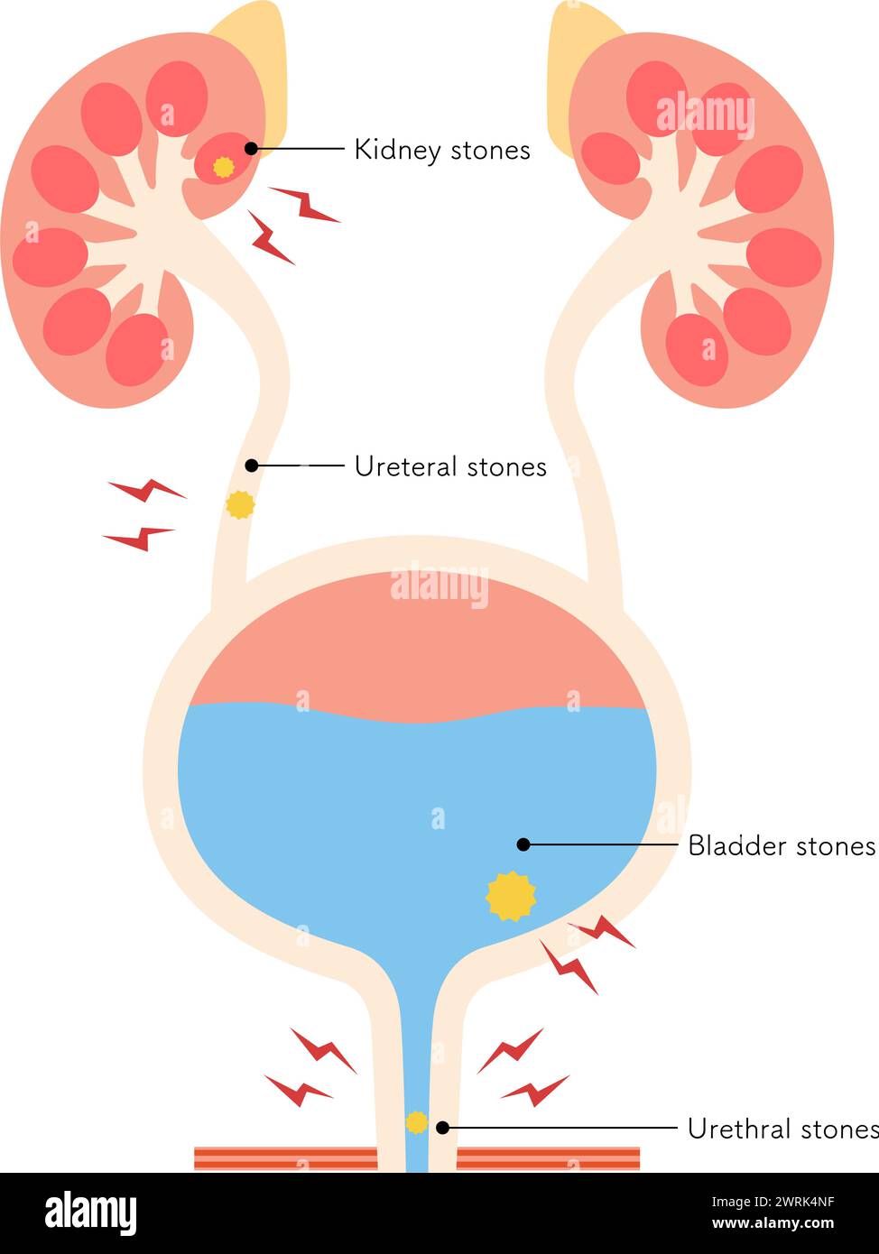 Medical illustration of urinary tract stones, Vector Illustration Stock ...
