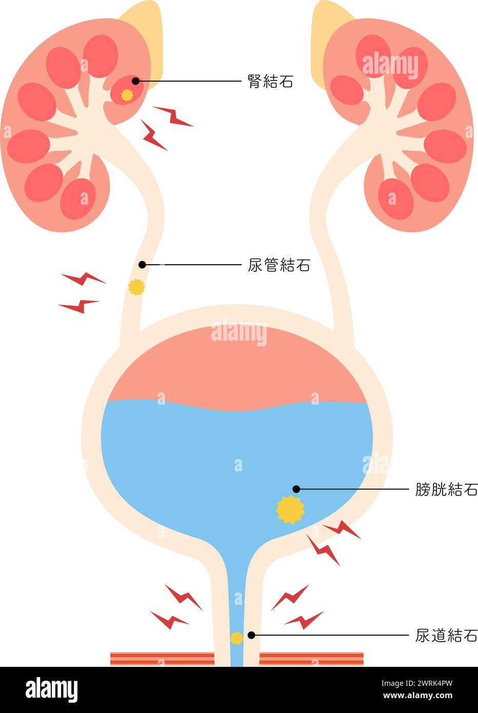 Medical illustration of urinary tract stones - Translation: Kidney ...