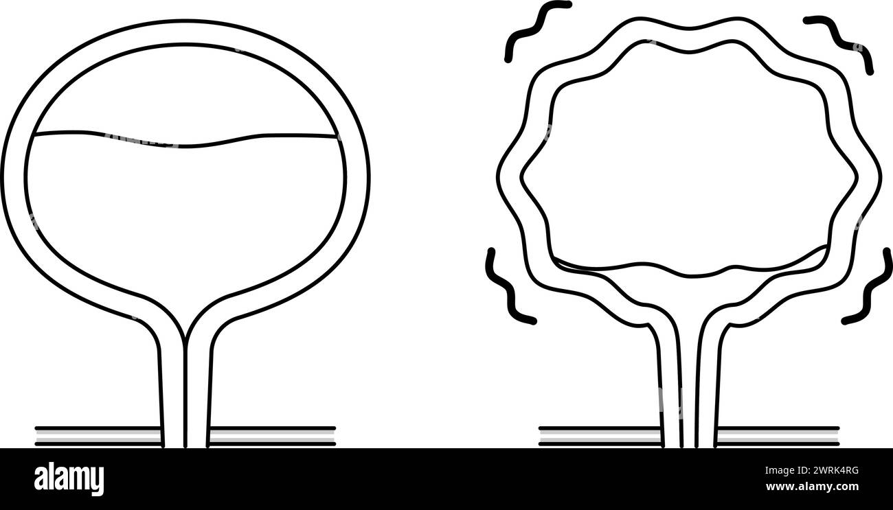 Medical illustration of overactive bladder, normal bladder vs, Vector Illustration Stock Vector ...