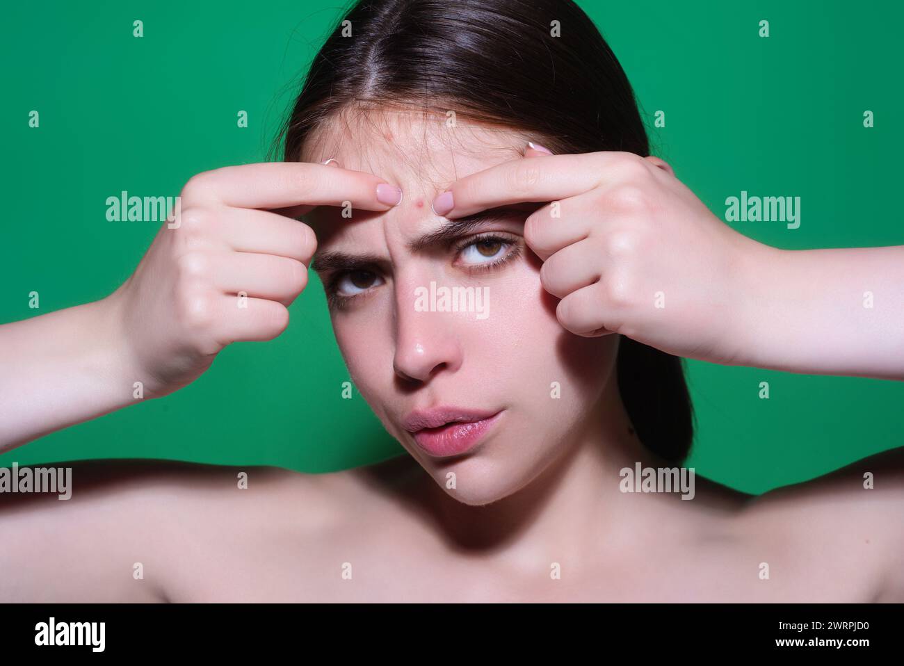 Young Woman Squeeze pimples. Girl with Acne and Pimple on Skin ...