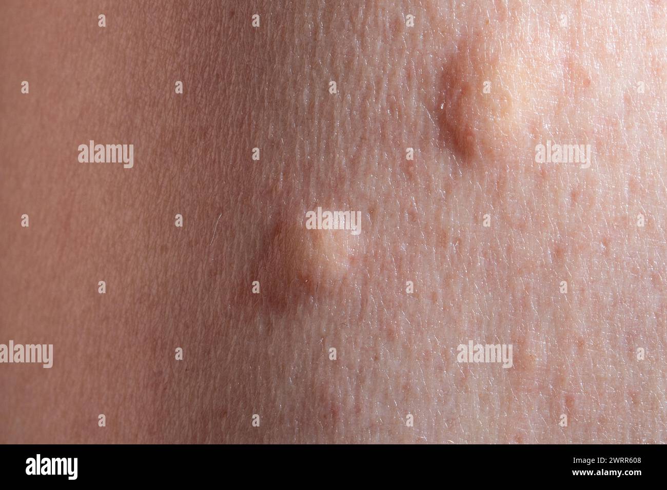 Macro shot highlighting two mosquito bites on the skin's surface, with ...