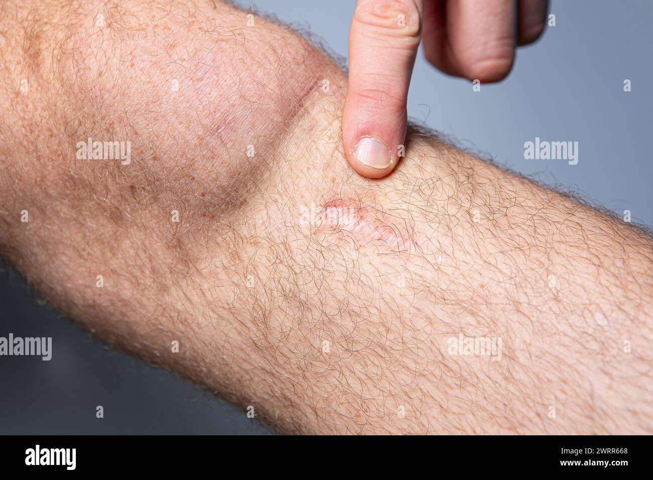 Close-up of a swollen red area on the skin of a man's arm Stock Photo ...