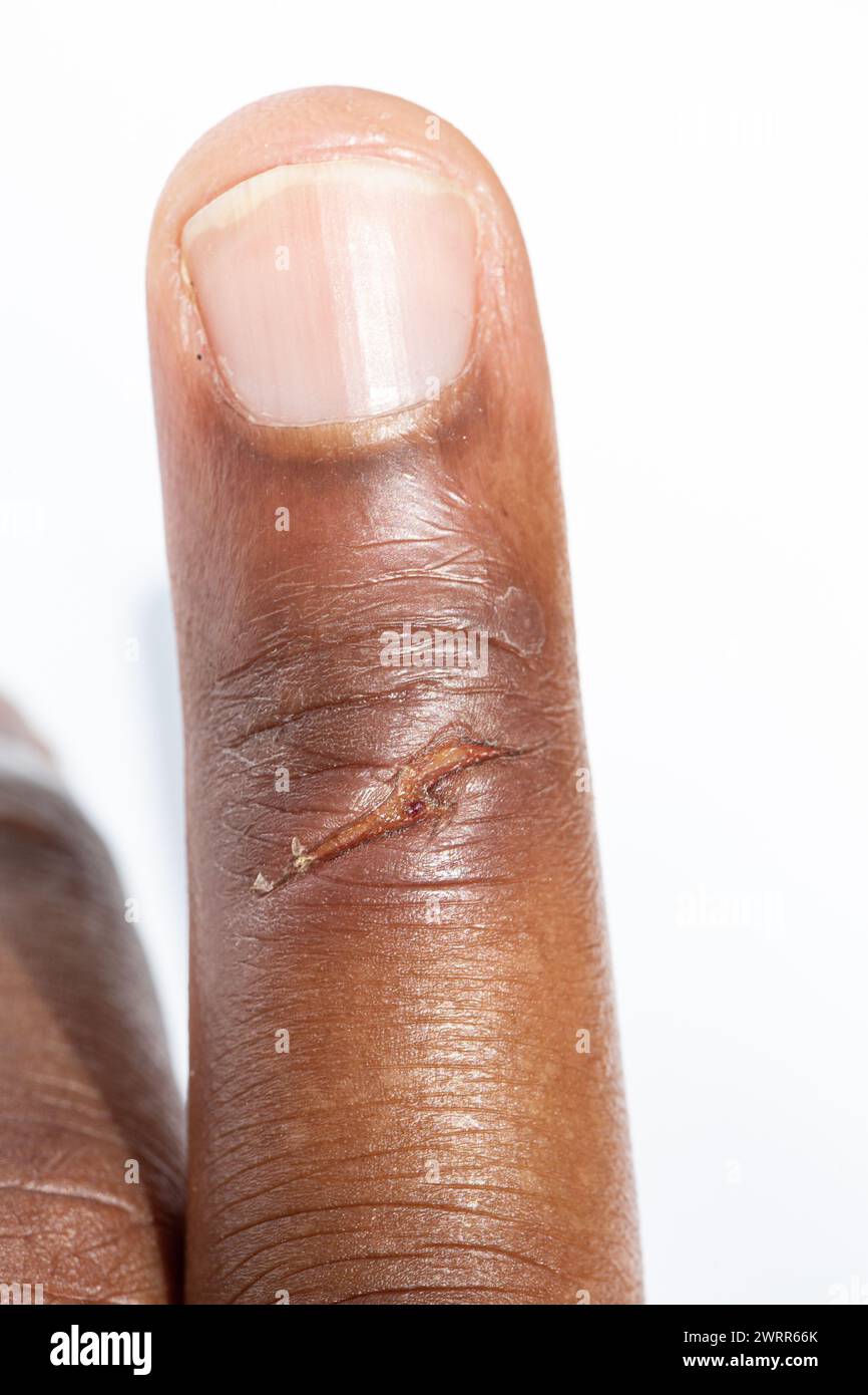 A macro shot showcases the details of a healing scab on a finger ...