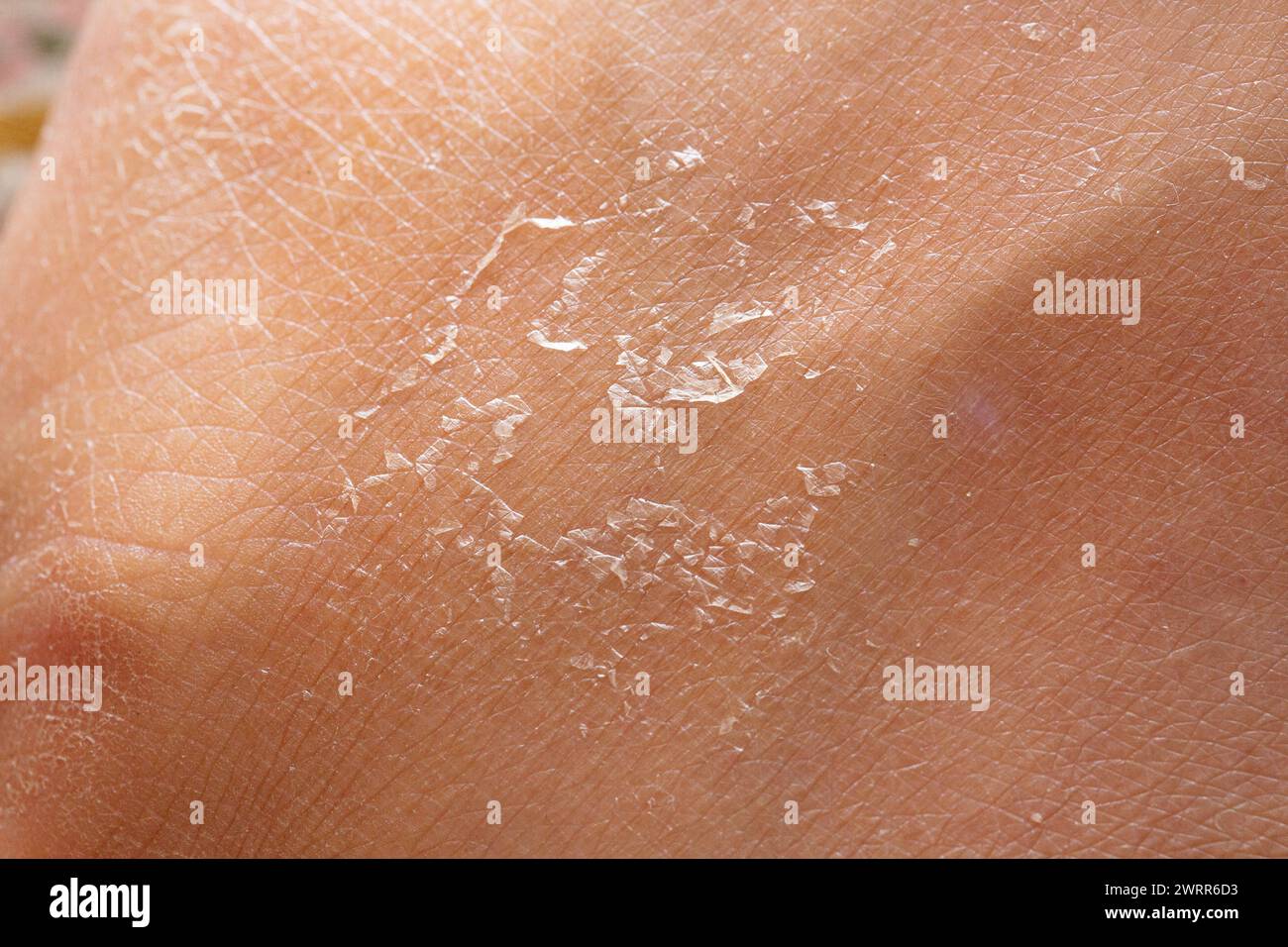 Macro shot of dry human skin flaking and peeling on the surface Stock ...