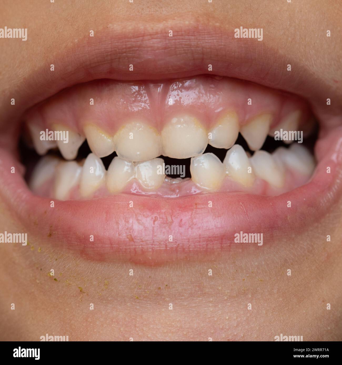 Close-up of a child's open mouth showing a gap from a lost baby tooth ...