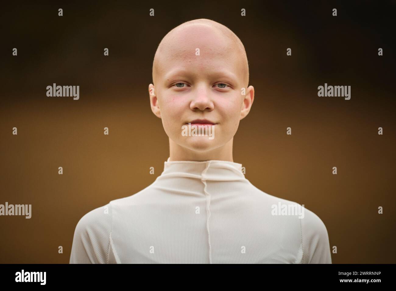 Portrait of young hairless girl with alopecia in white cloth on autumn ...