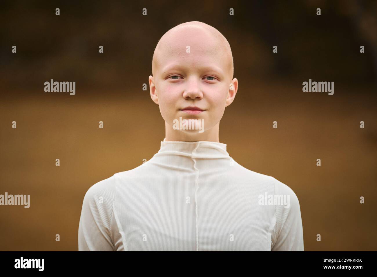 Portrait of young hairless girl with alopecia in white cloth on autumn ...