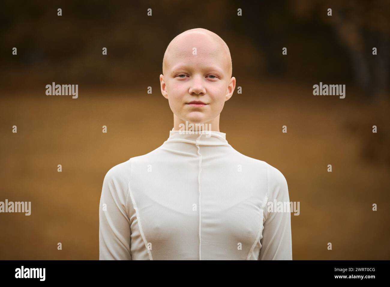 Portrait of young hairless girl with alopecia in white cloth on autumn ...
