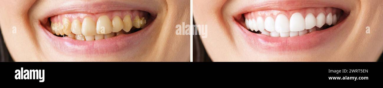 A woman's smile in close-up, the result of teeth whitening before and ...