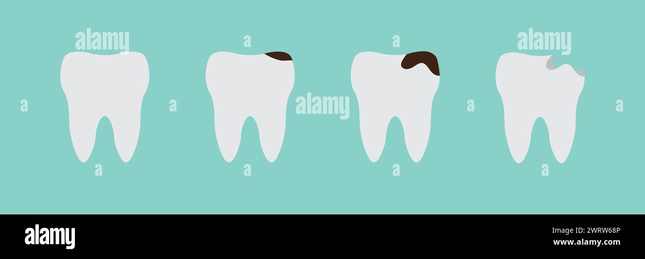 Teeth on different stages of caries. Tooth decay, toothache. Deep ...