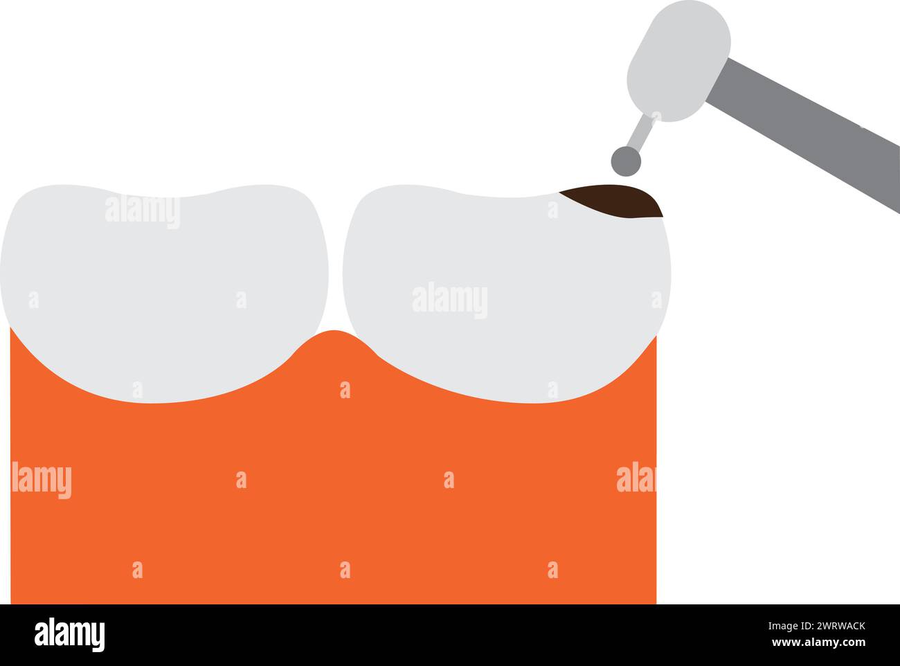 Dental cavity concept.. Smiling healthy teeth with sad decay tooth ...