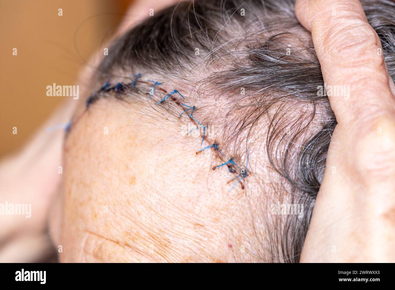 large stitched wound to the head of an elderly woman, Balance problems ...