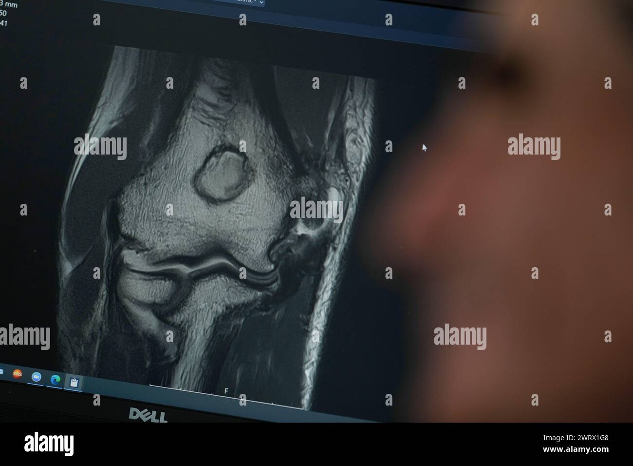 Dr. David Altchek talks about some aspects of Tommy John surgery while ...