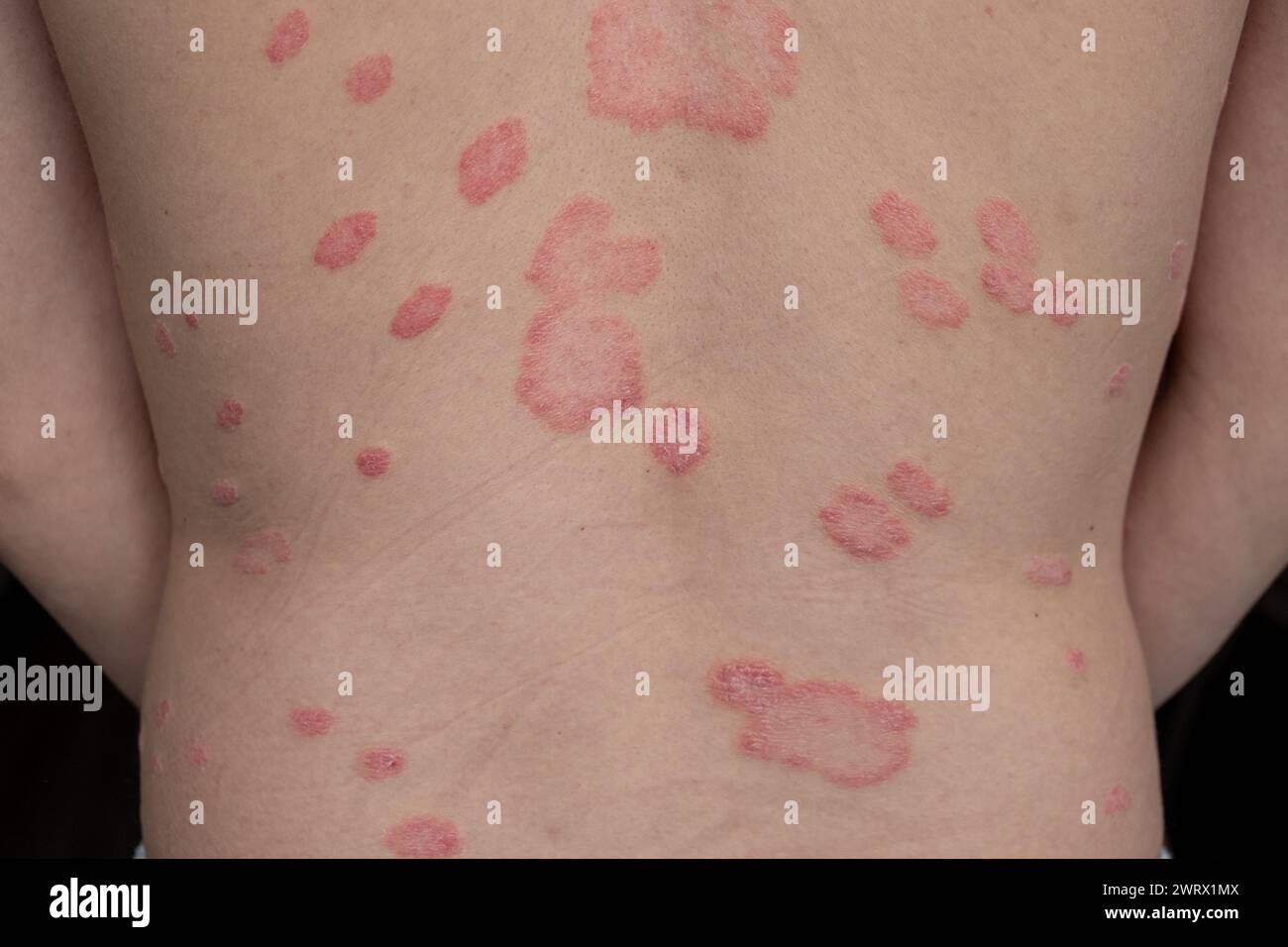 Psoriasis vulgaris hi-res stock photography and images - Alamy