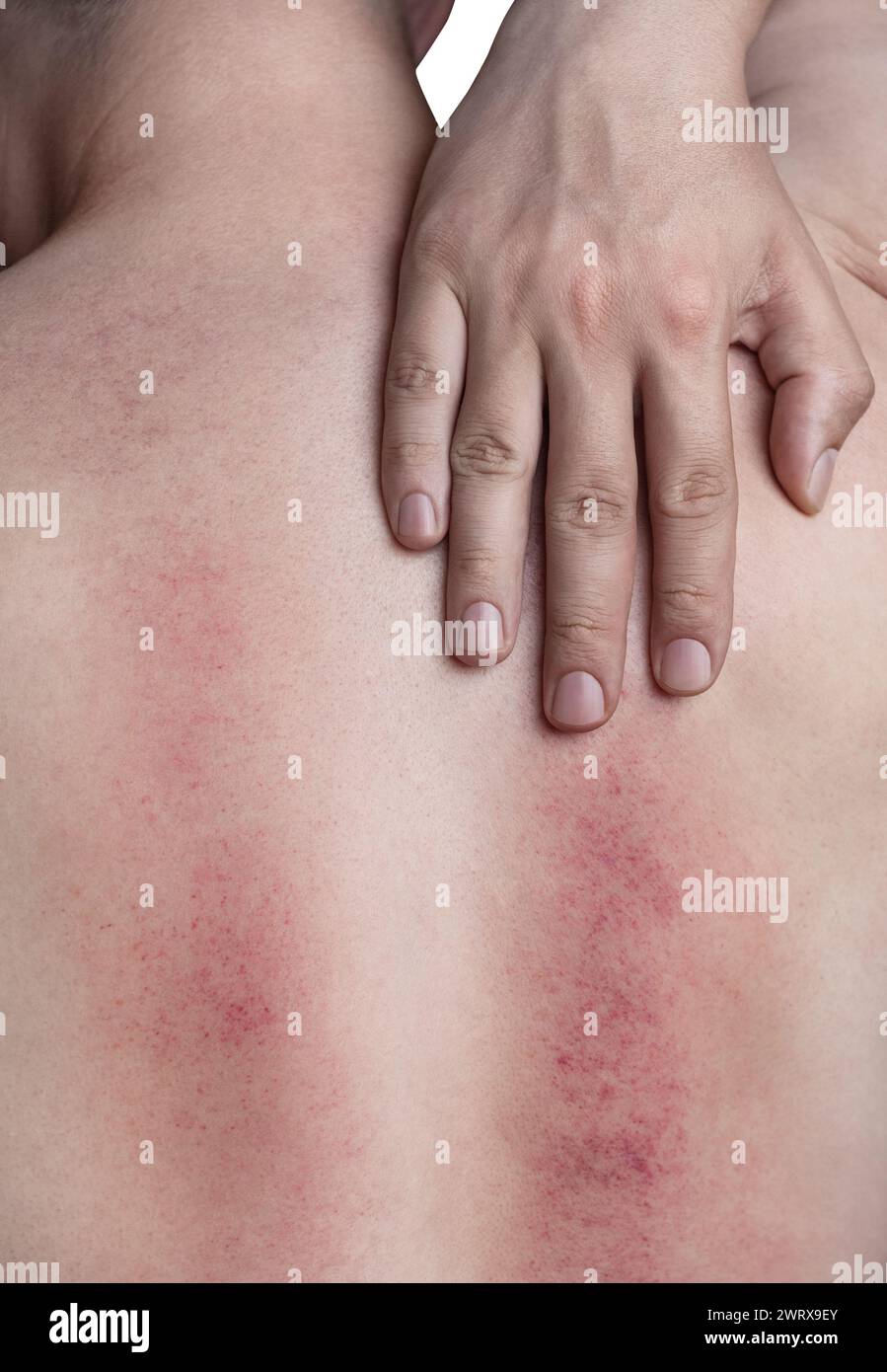 Gore and redness on the back of the man along the spine as a result of ...