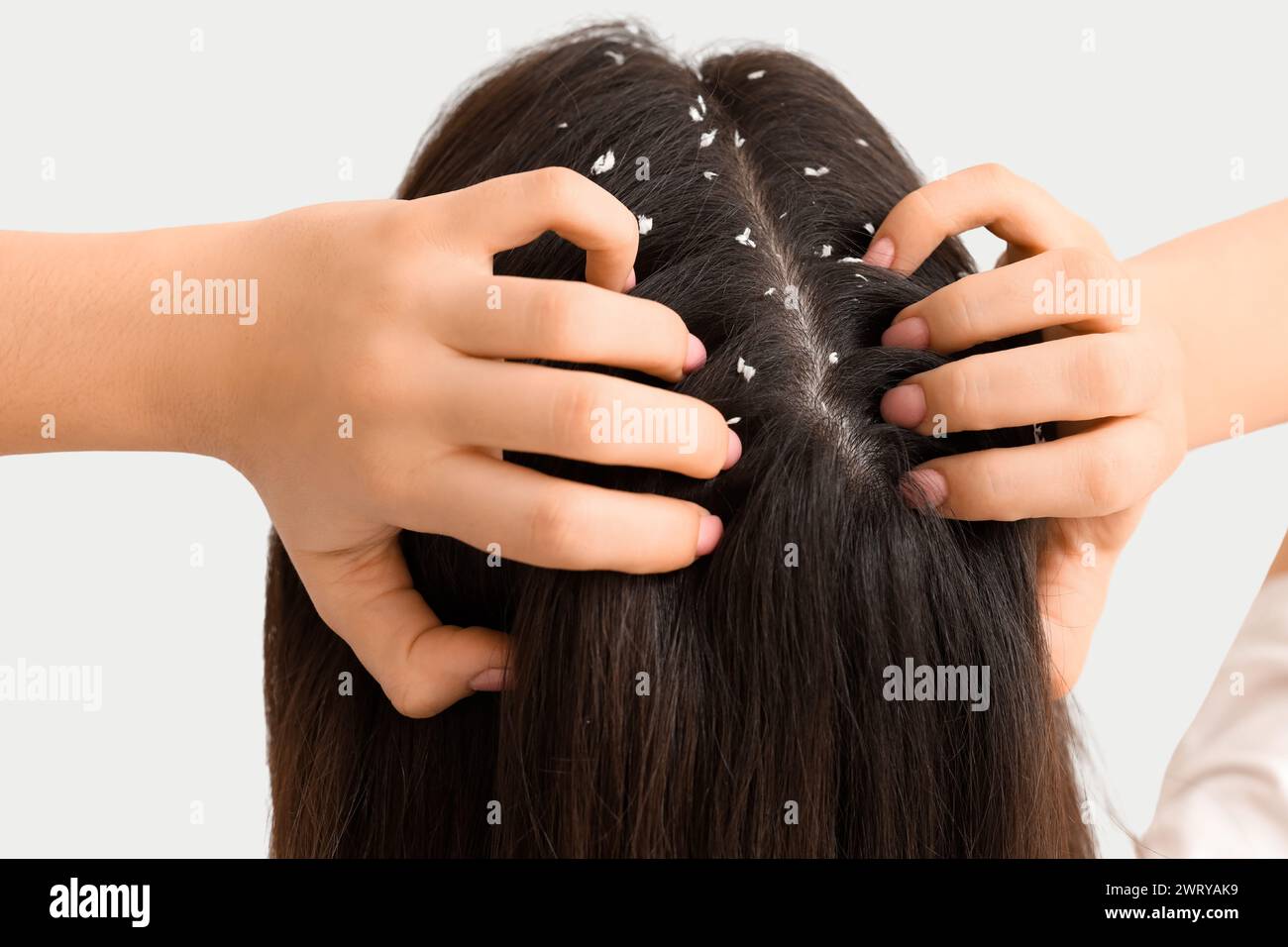 Young woman with dandruff problem scratching head on white background ...