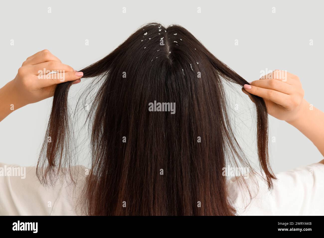 Young woman with dandruff problem on white background, back view Stock ...