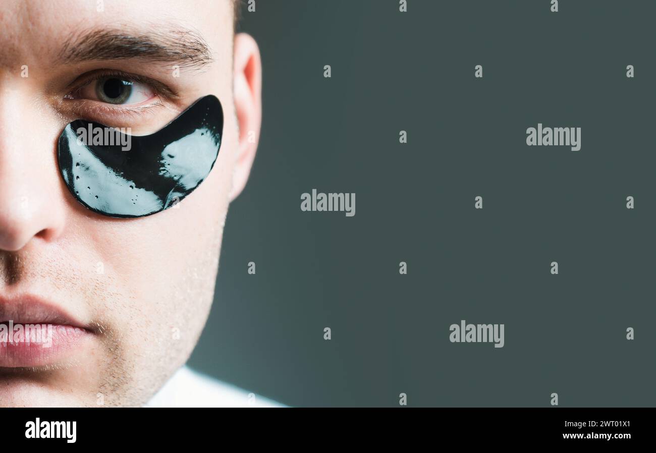 Man face with flakes under the eyes. Mans flakes. Patches under close ...