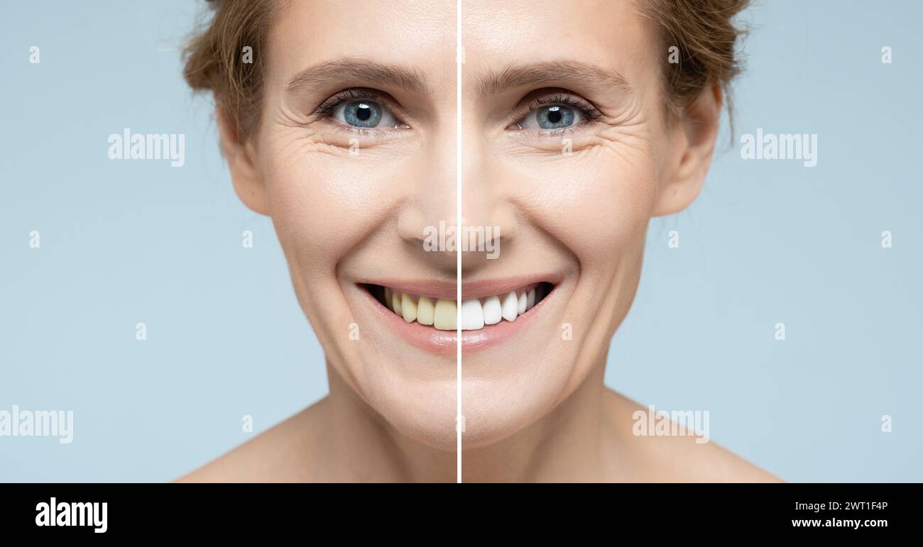 Collage of female smile before and after teeth whitening. Advertising ...