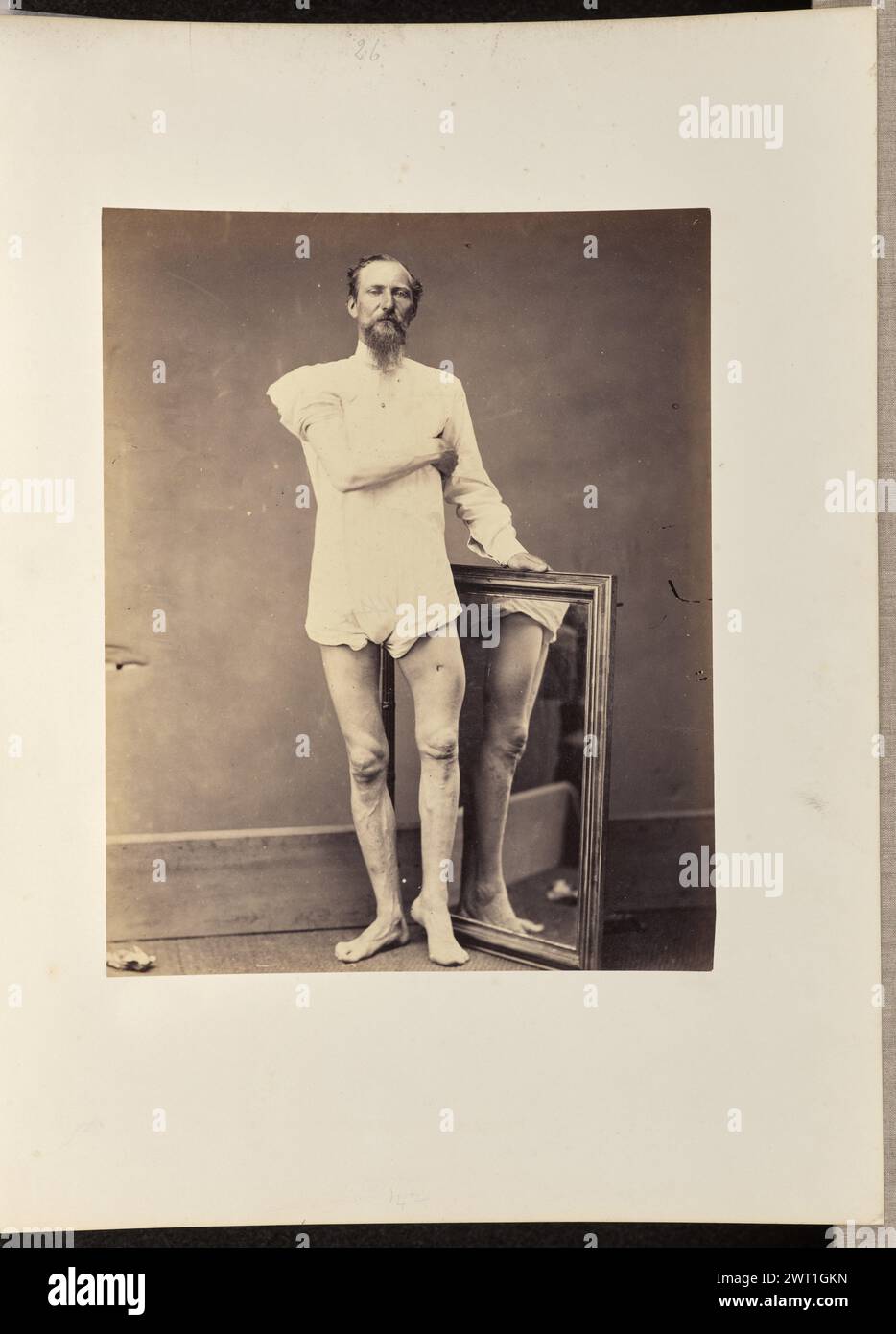 Consolidated Gunshot Fracture of the Middle Third of the Left Femur ...