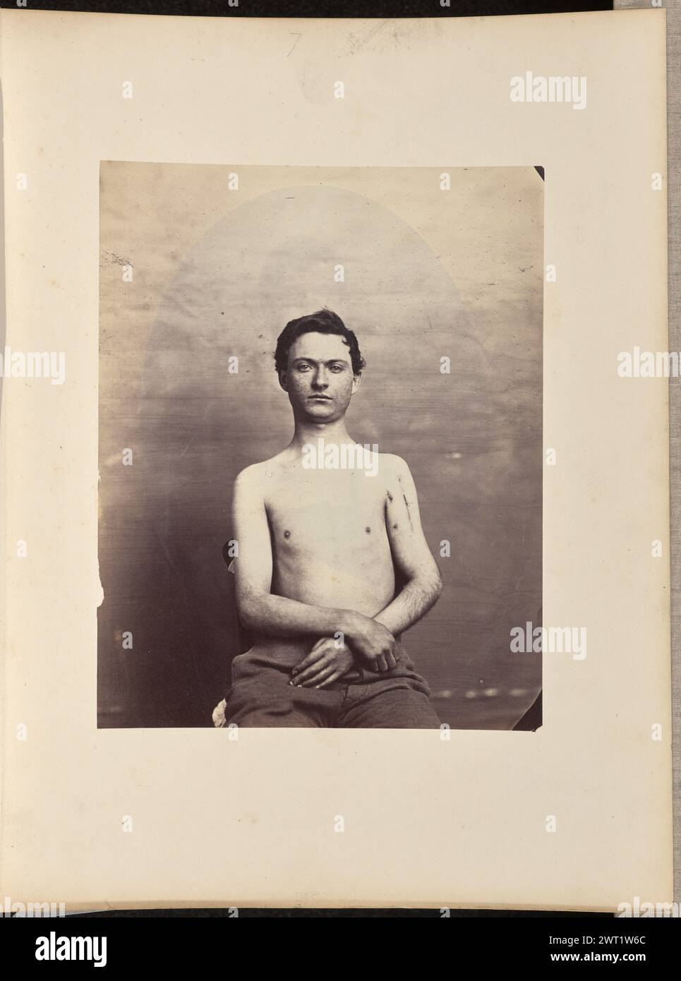 Recovery after Excision of the Head of the Left Humerus for Gunshot ...