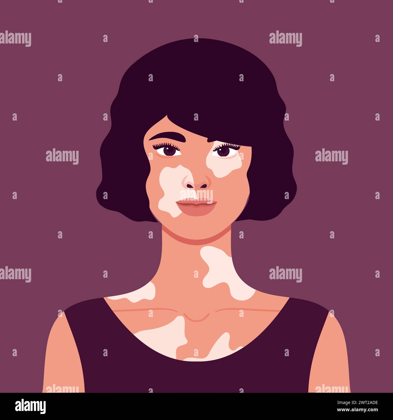 Beautiful young woman with vitiligo depigmentation. Rare appearance ...