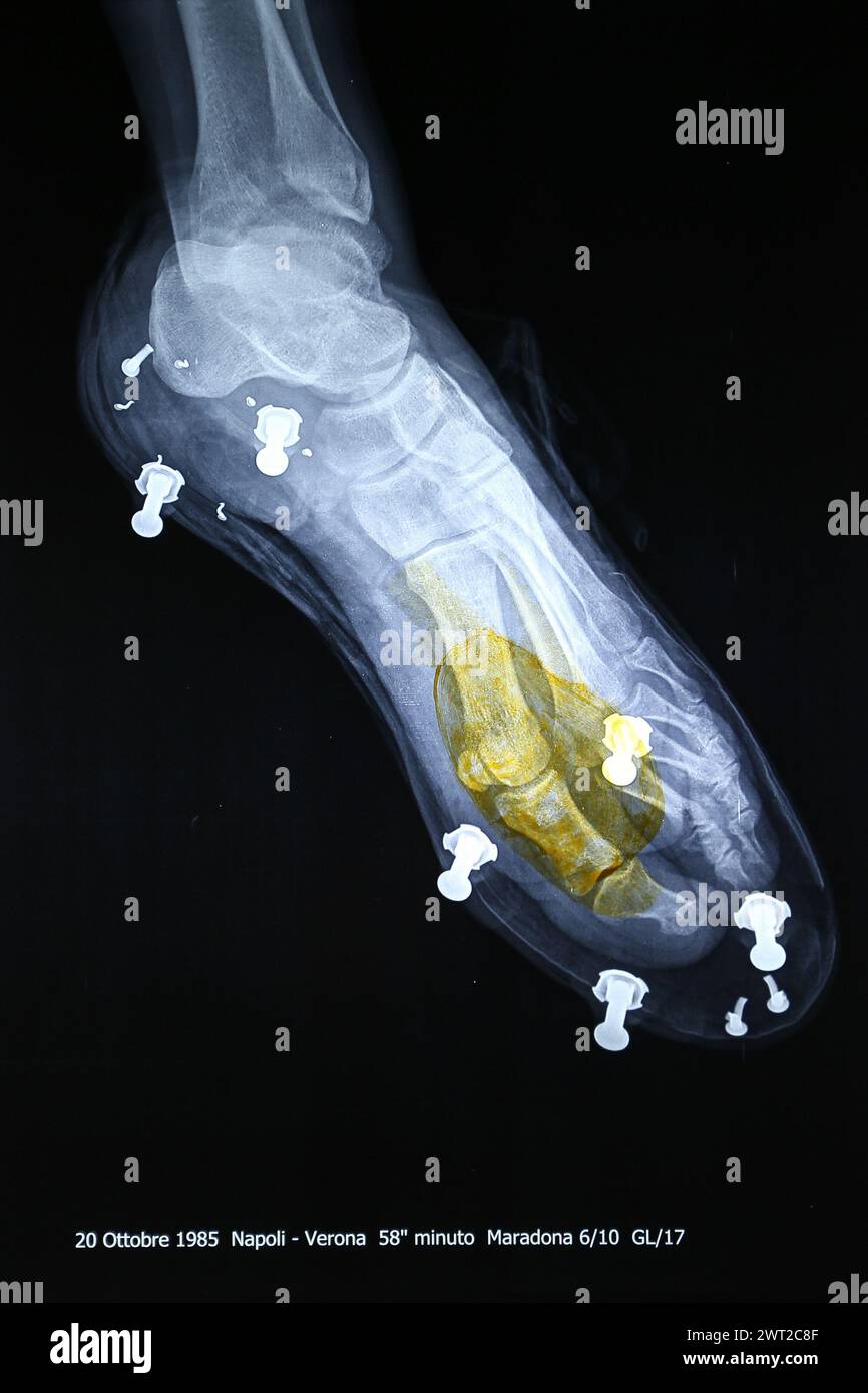 An x-ray of Diego Armando Maradona's foot in the museum of madness ...