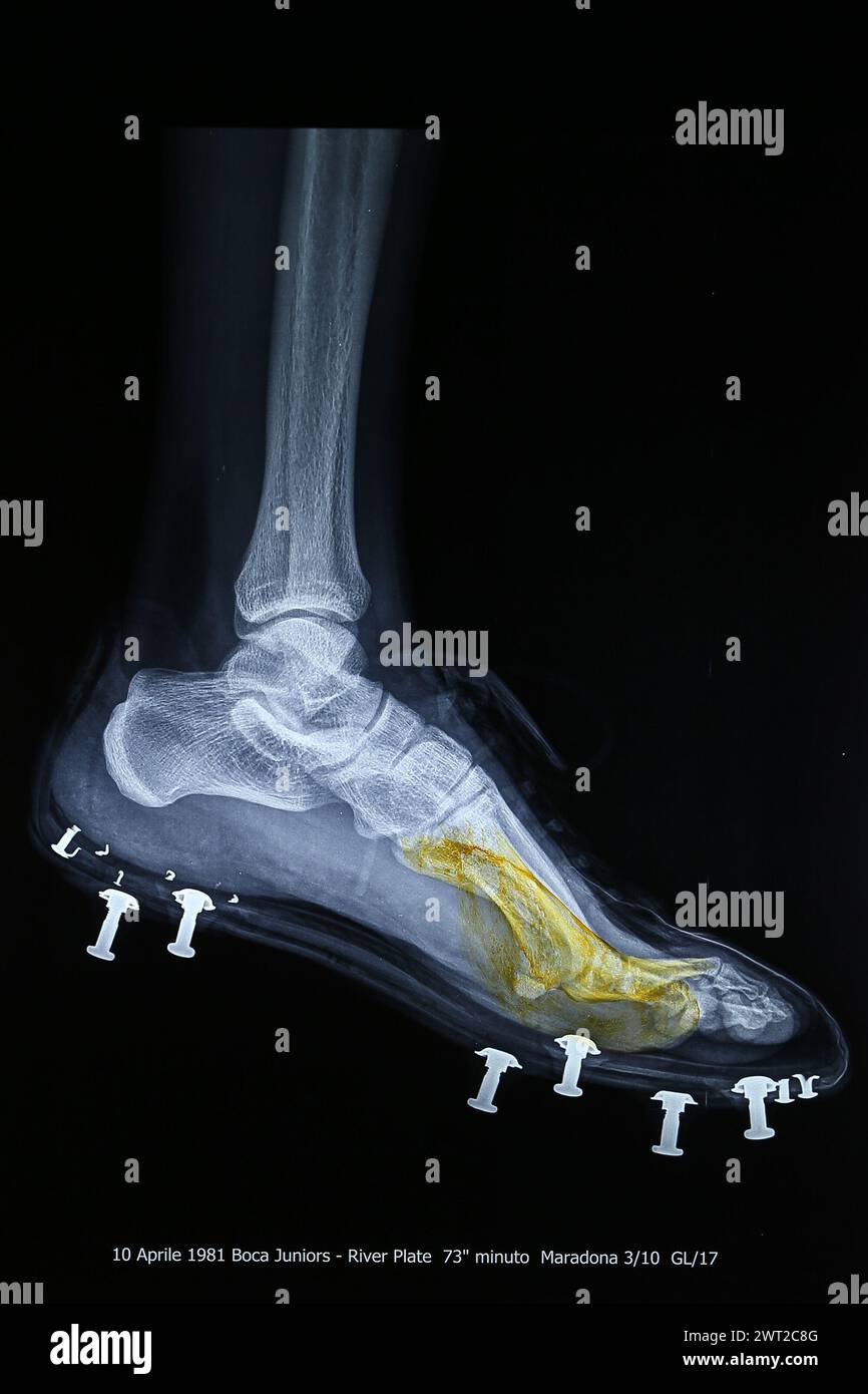 An x-ray of Diego Armando Maradona's foot in the museum of madness ...
