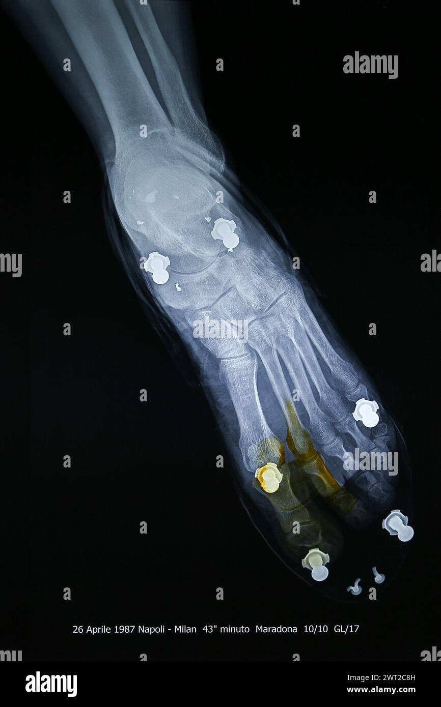 An x-ray of Diego Armando Maradona's foot in the museum of madness ...