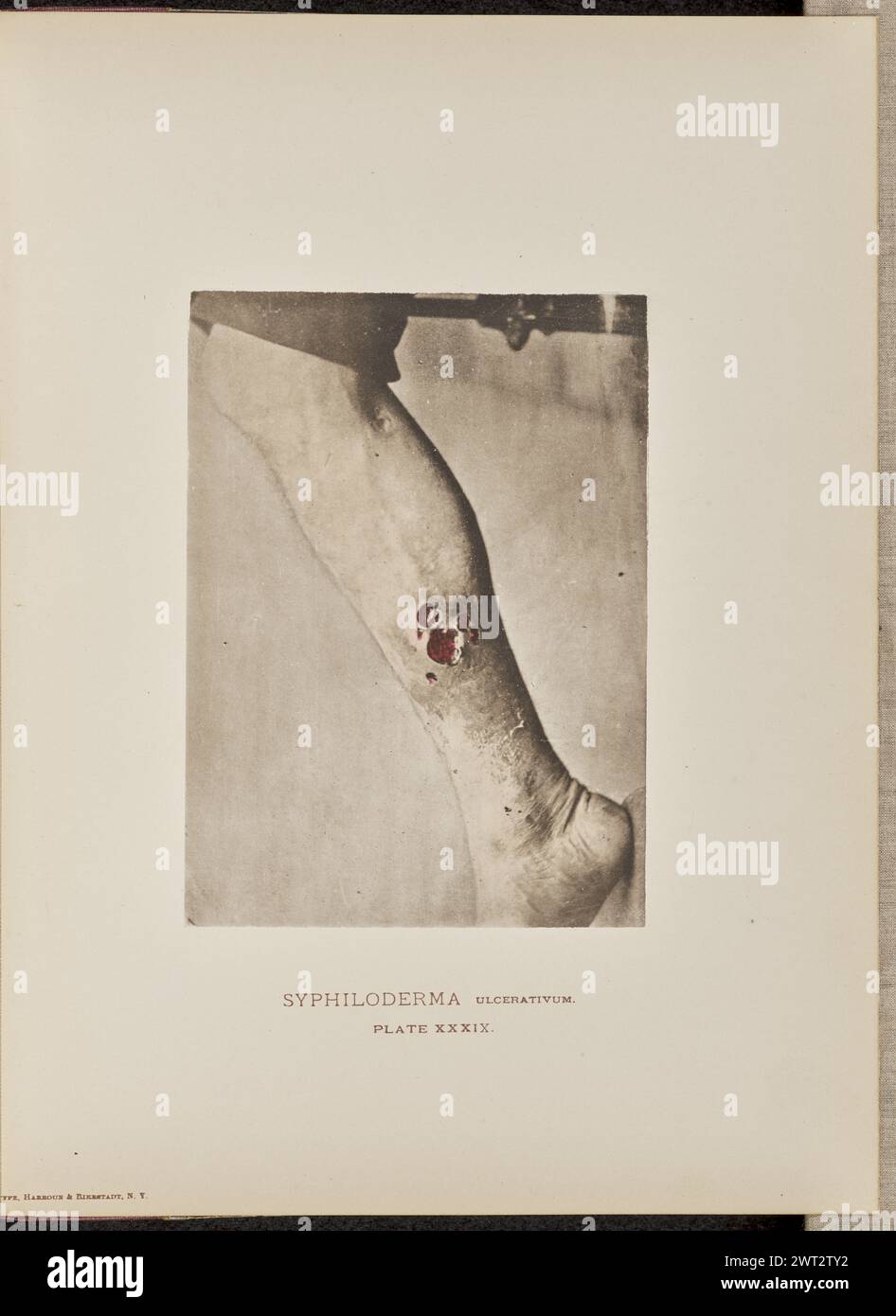 Secondary syphilis hi-res stock photography and images - Alamy