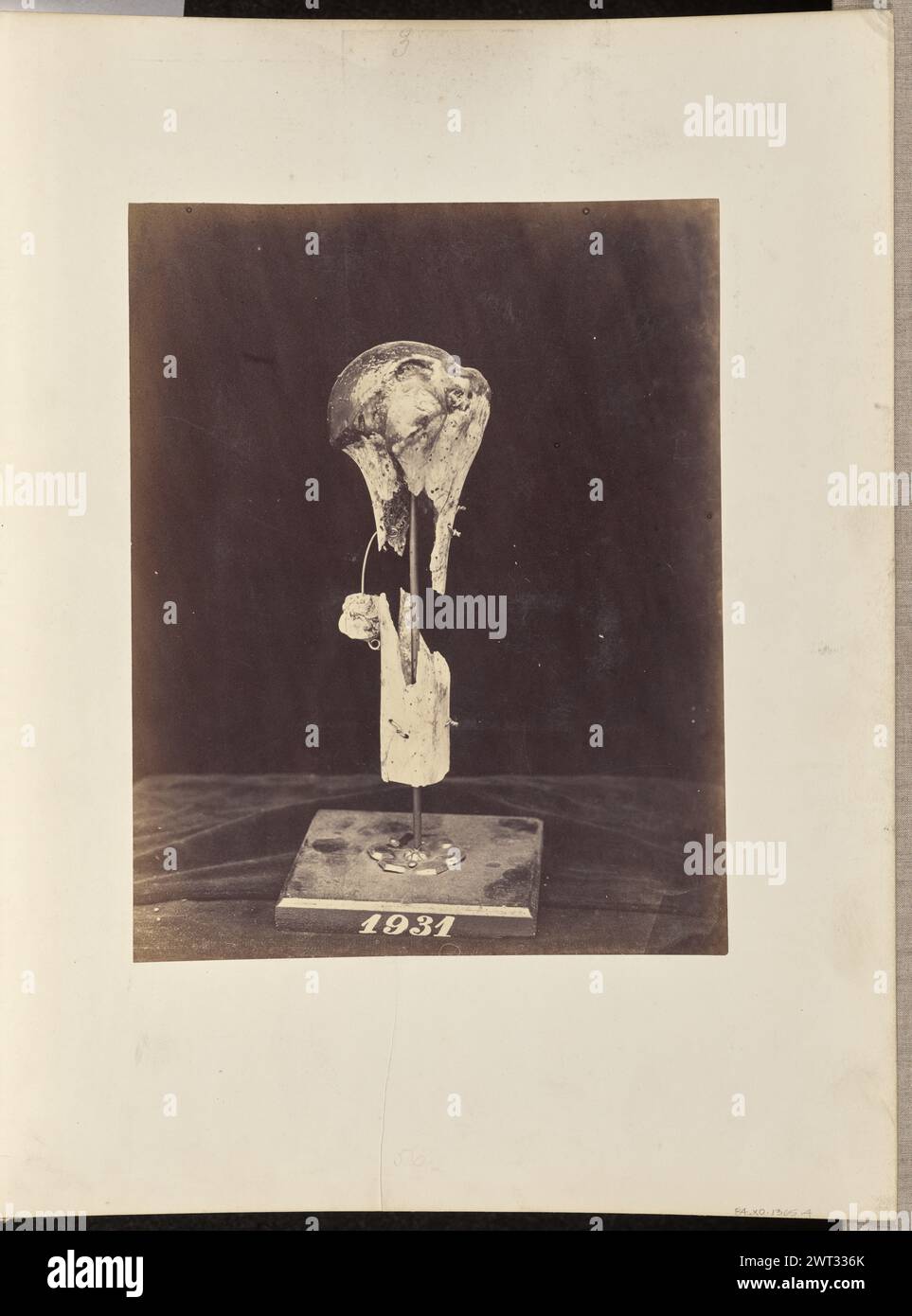 Excised Head and Comminuted Upper-Portion of Shaft of Left Humerus ...