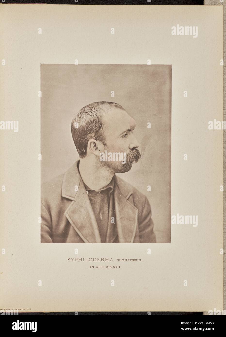 Gumma tertiary syphilis hi-res stock photography and images - Alamy Gumma tertiary syphilis hi-res stock photography and images - Alamy