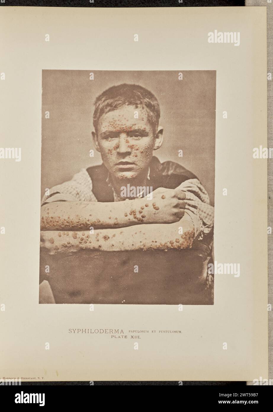 Syphiloderma papulosum et pustulosum. Dr. George Henry Fox ...