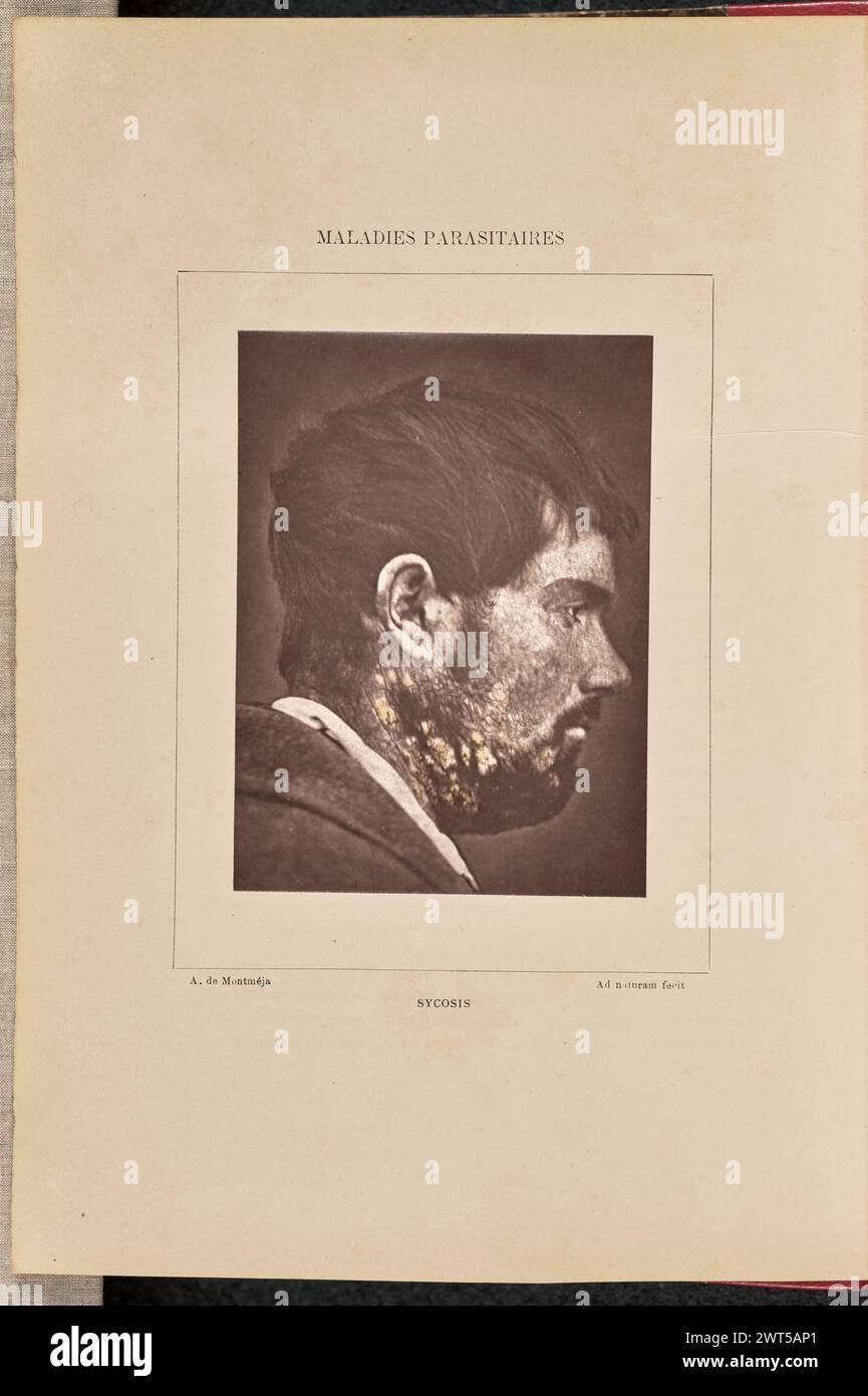 Sycosis. Arthur de Montmeja, photographer (French, born 1841) negative ...