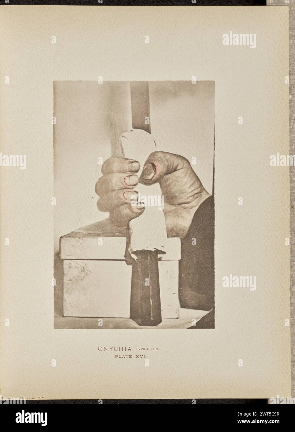 Onychia syphilitica. Dr. George Henry Fox, photographer (American, 1846 ...